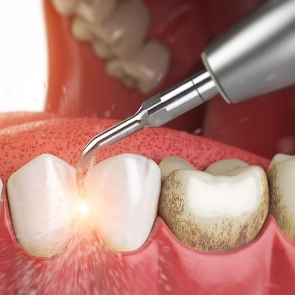 Pinhole® Surgical Technique - The Smile Centre